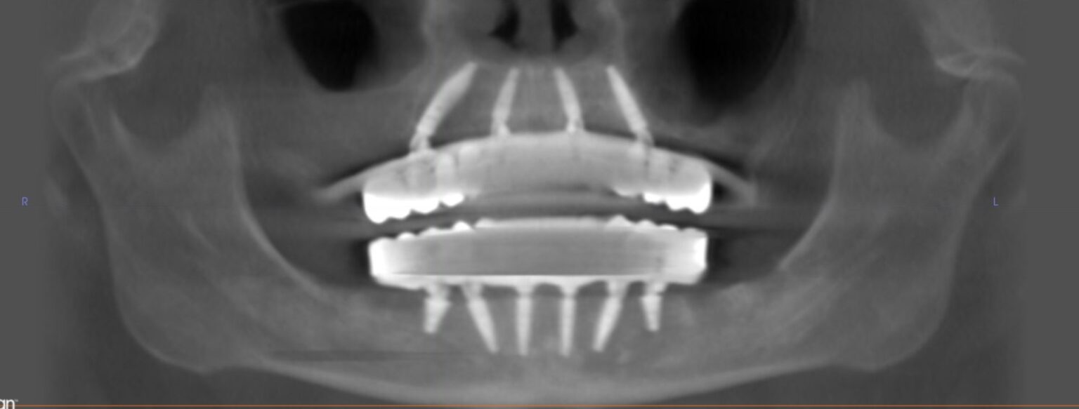 The Piriform Rim: Pearls & Pitfalls - AOX Surgery