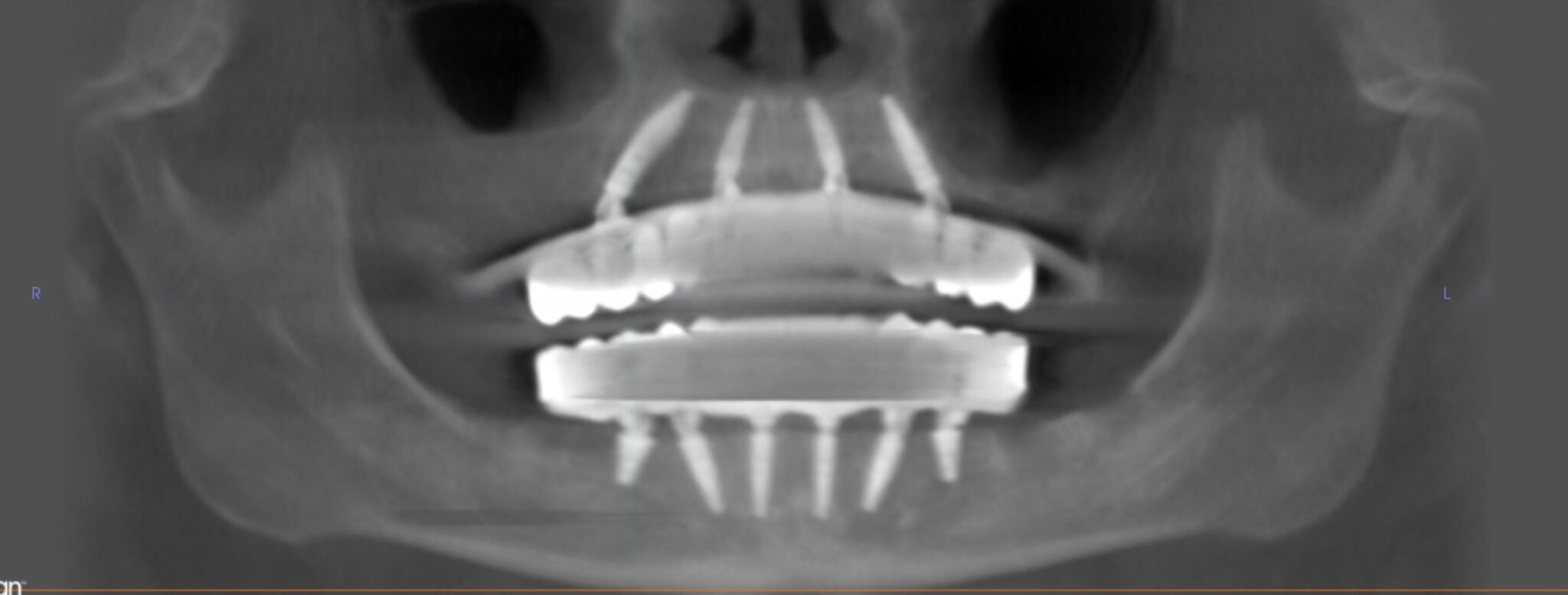 The Piriform Rim: Pearls & Pitfalls - AOX Surgery