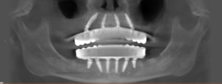 The Piriform Rim: Pearls & Pitfalls - AOX Surgery