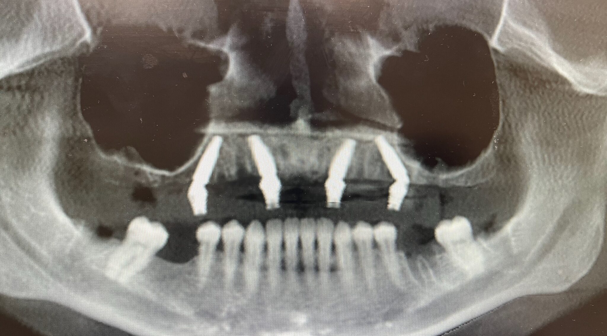 Why I Converted to an Inverted V Configuration - AOX Surgery