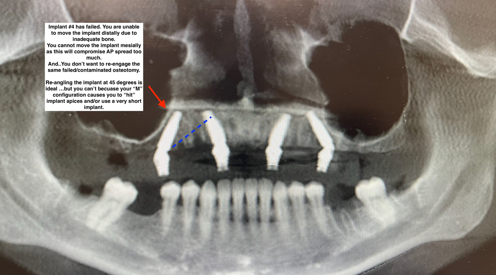 Why I Converted to an Inverted V Configuration - AOX Surgery