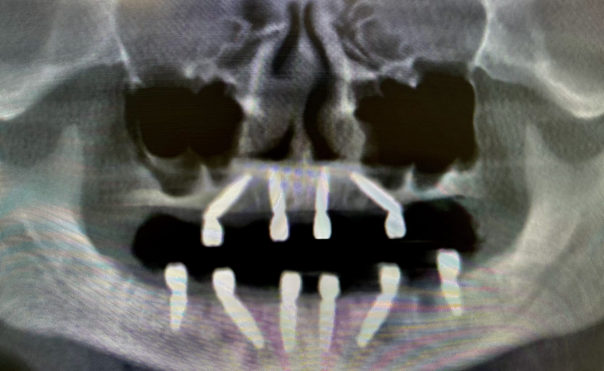 Why I Converted to an Inverted V Configuration - AOX Surgery
