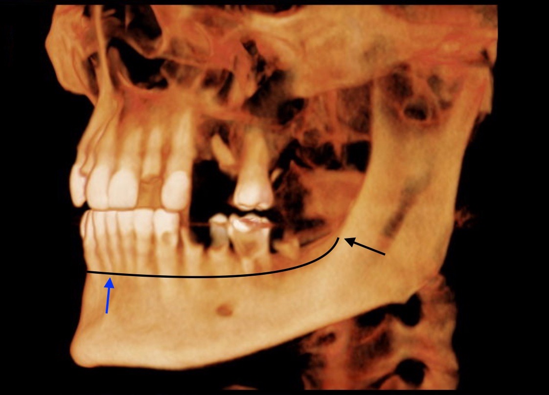 How to Ensure Adequate Mandibular Reduction Without a Guide - AOX Surgery