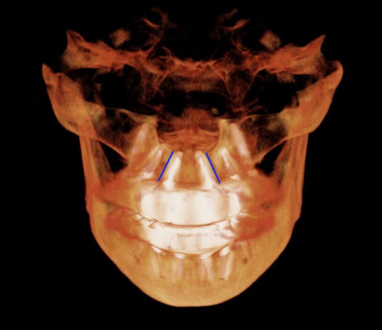 Why I Converted to an Inverted V Configuration - AOX Surgery