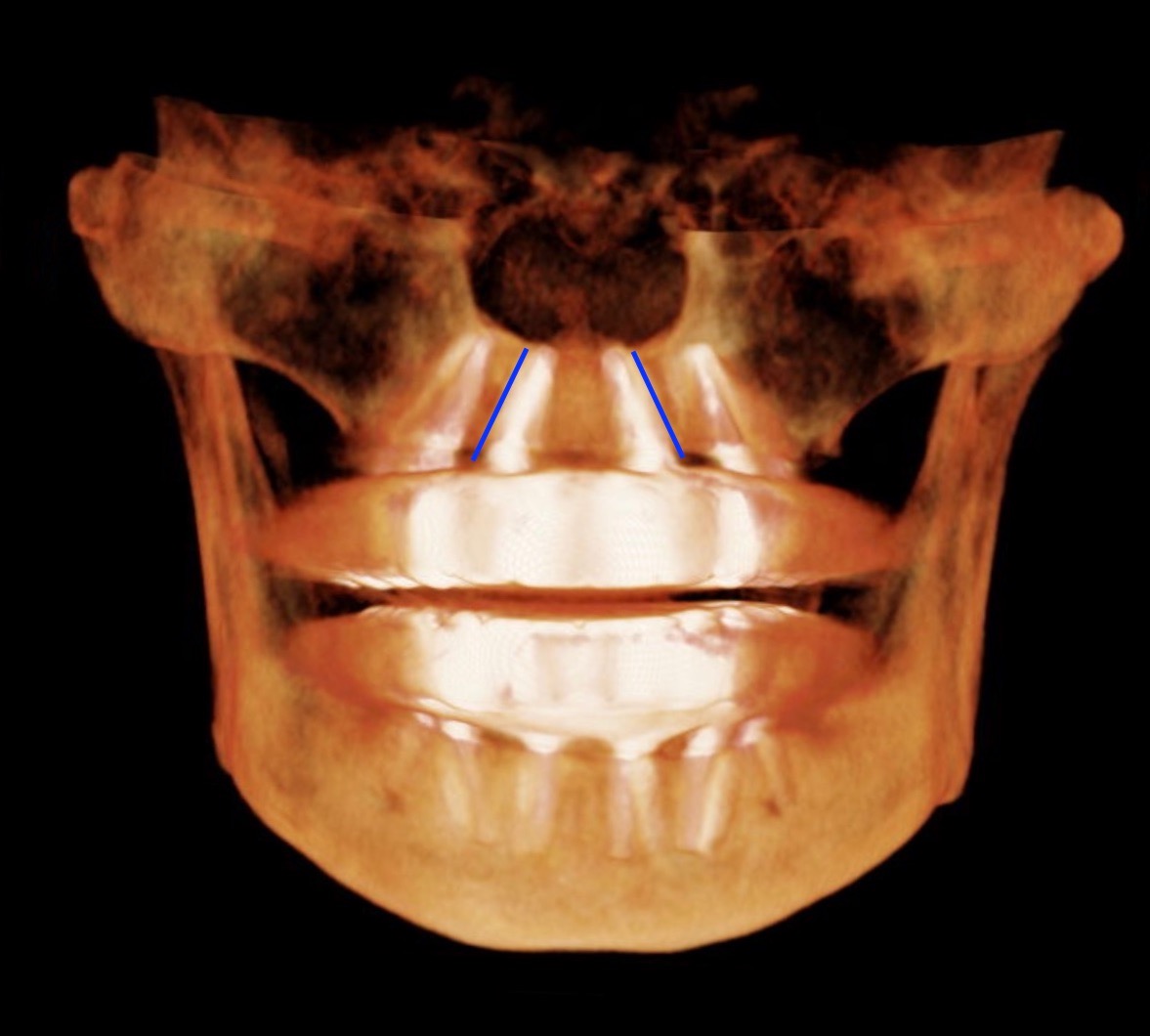 Why I Converted to an Inverted V Configuration - AOX Surgery