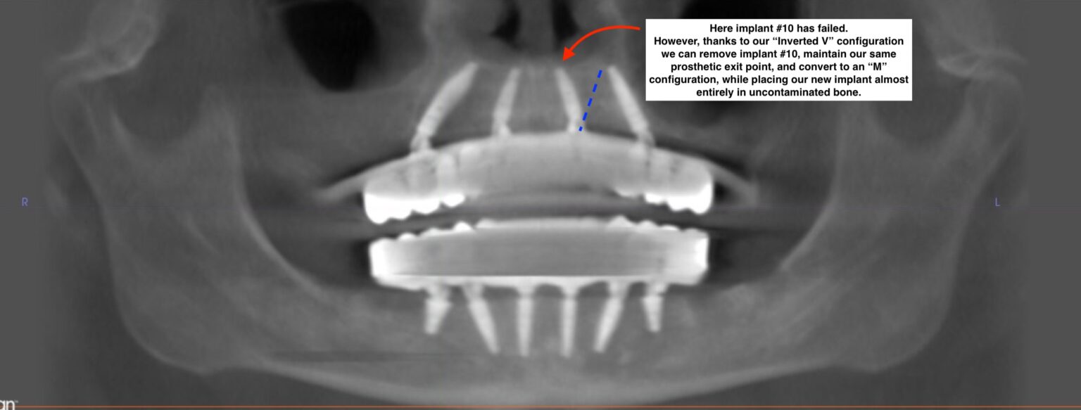 Why I Converted to an Inverted V Configuration - AOX Surgery