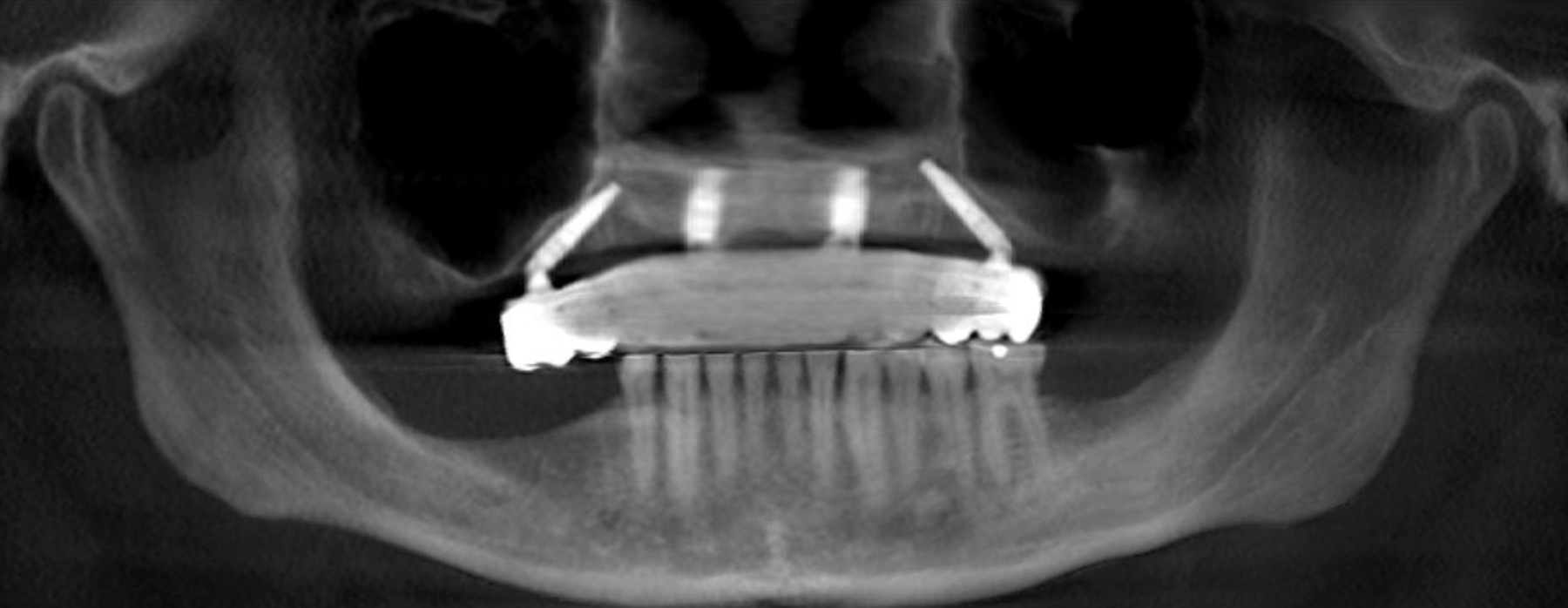 The Cardinal Rule of All-On-X Surgery - AOX Surgery