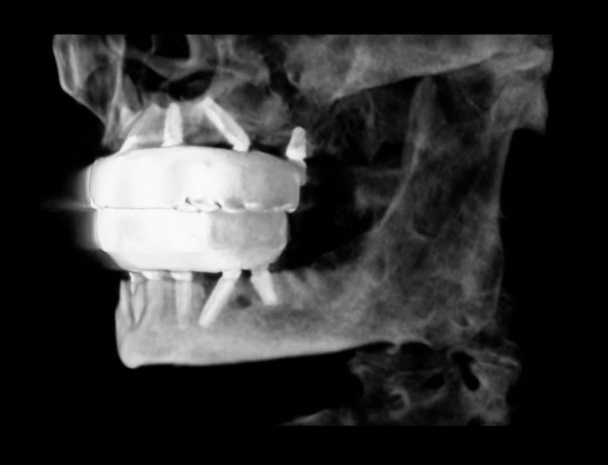 The Benefits of A Tapered Implant in AOX Surgery - AOX Surgery