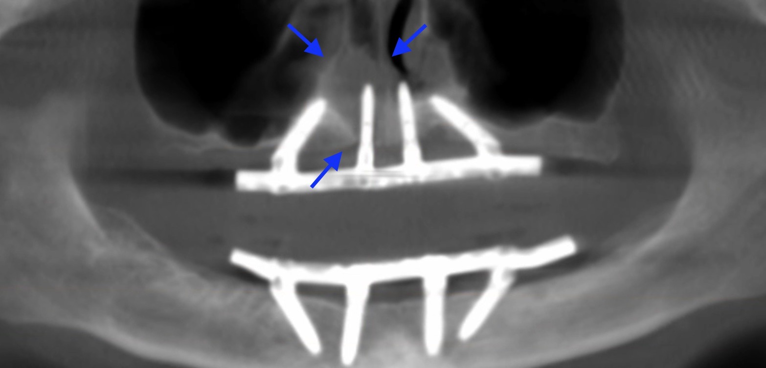 The Piriform Rim: Pearls & Pitfalls - AOX Surgery