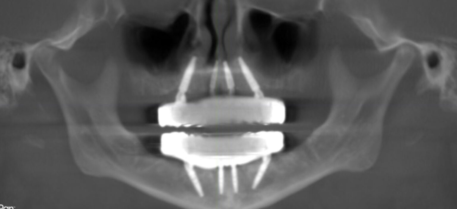 The Piriform Rim: Pearls & Pitfalls - AOX Surgery