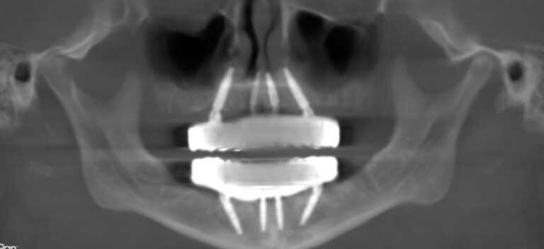 The Piriform Rim: Pearls & Pitfalls - AOX Surgery