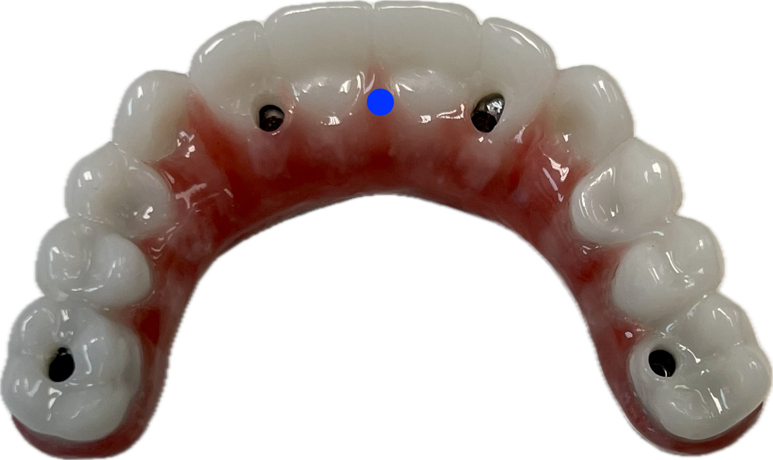 7 Reasons Why I Almost Never…Ever…Place a Midline Implant - AOX Surgery