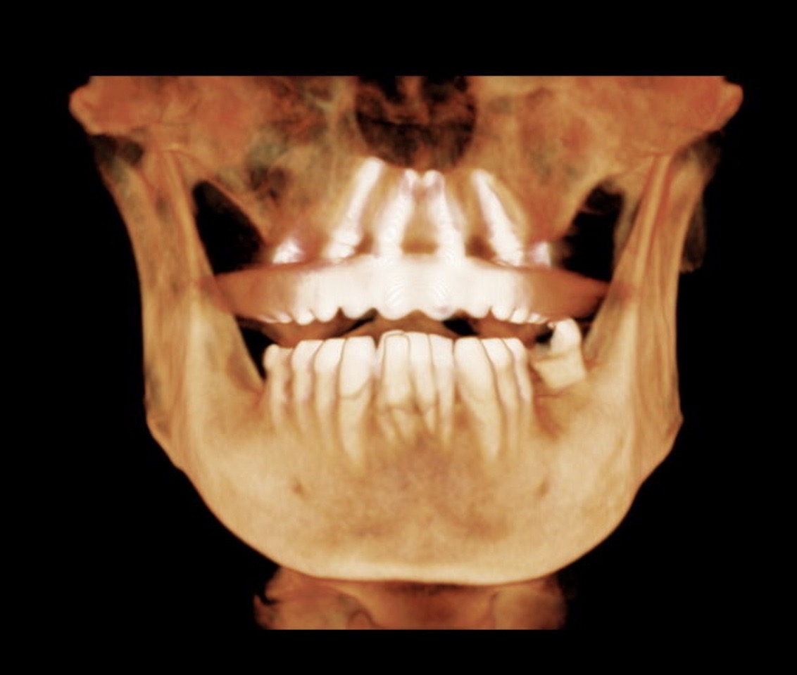 The Piriform Rim: Pearls & Pitfalls - AOX Surgery