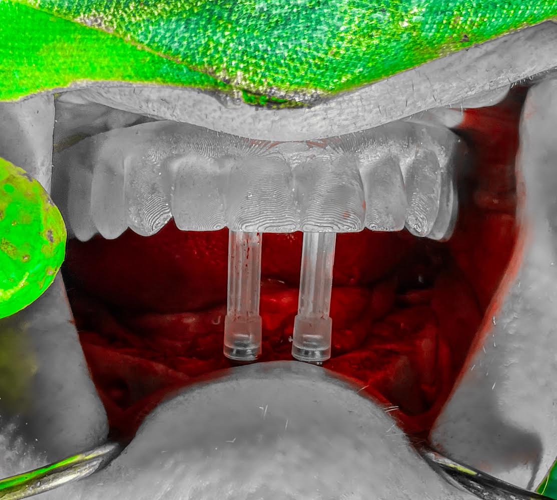 Abutment Placement: A Strategic Sequence - AOX Surgery