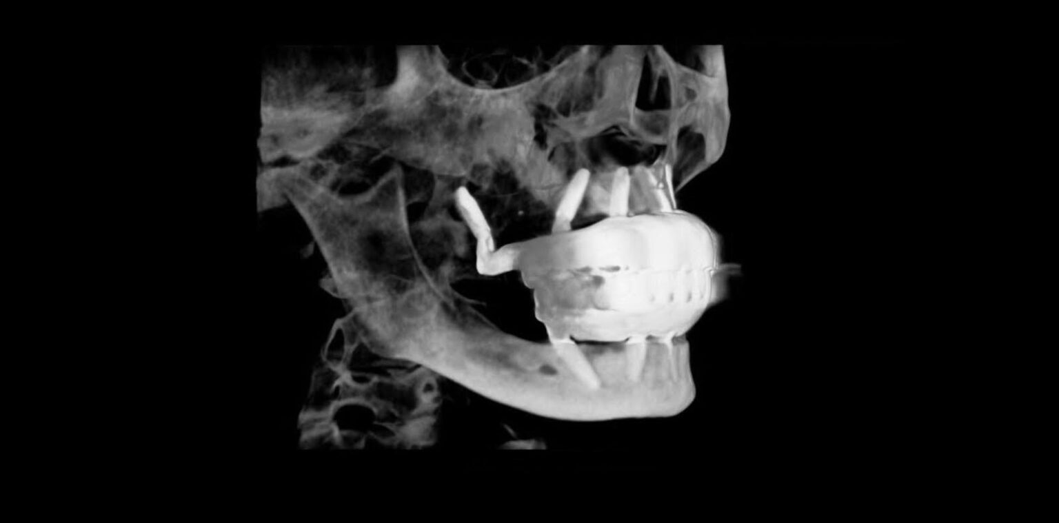 Why I Love “Graphite-Guided” All-On-X Surgery - AOX Surgery