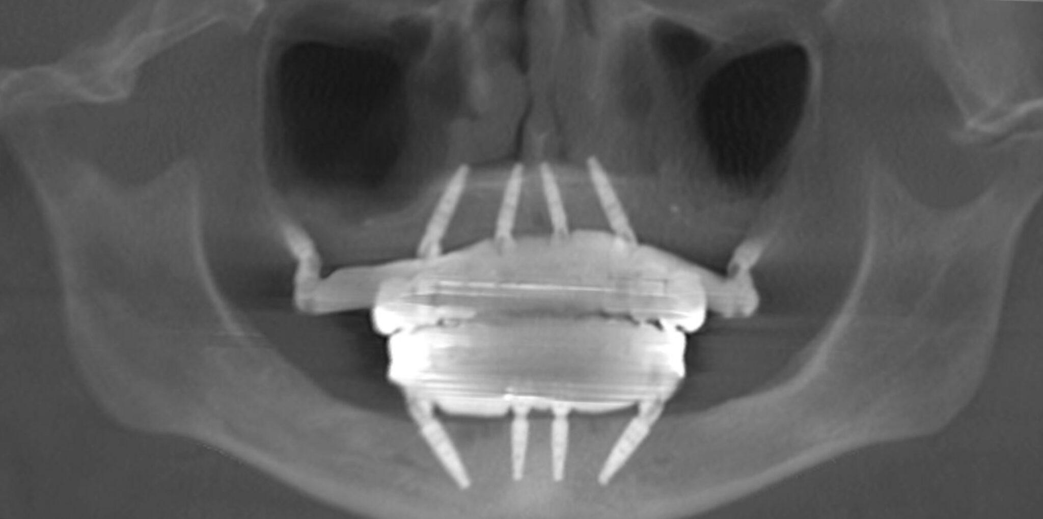 Why I Love “Graphite-Guided” All-On-X Surgery - AOX Surgery