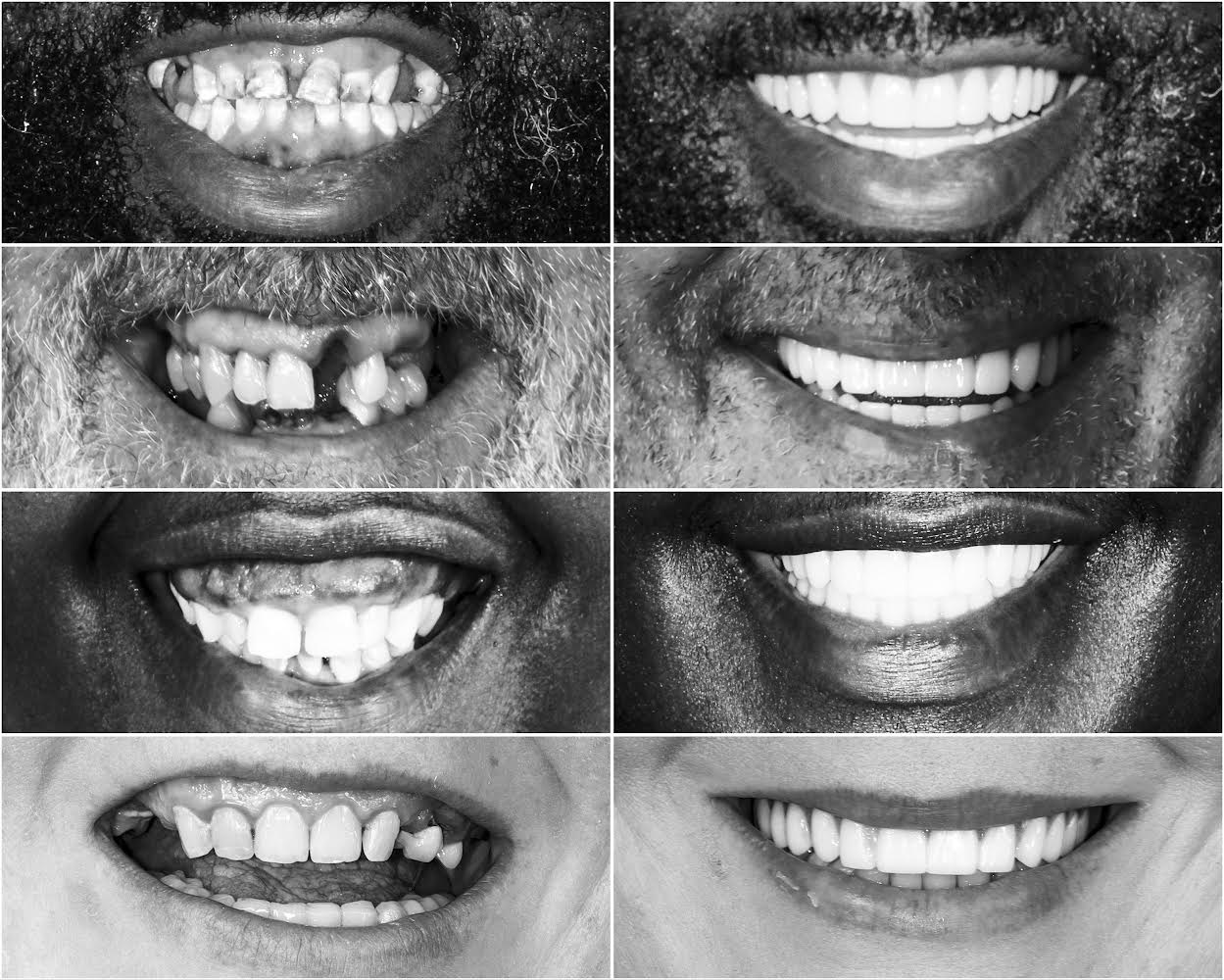 Surgical Management of the Dreaded High Smile Line - AOX Surgery