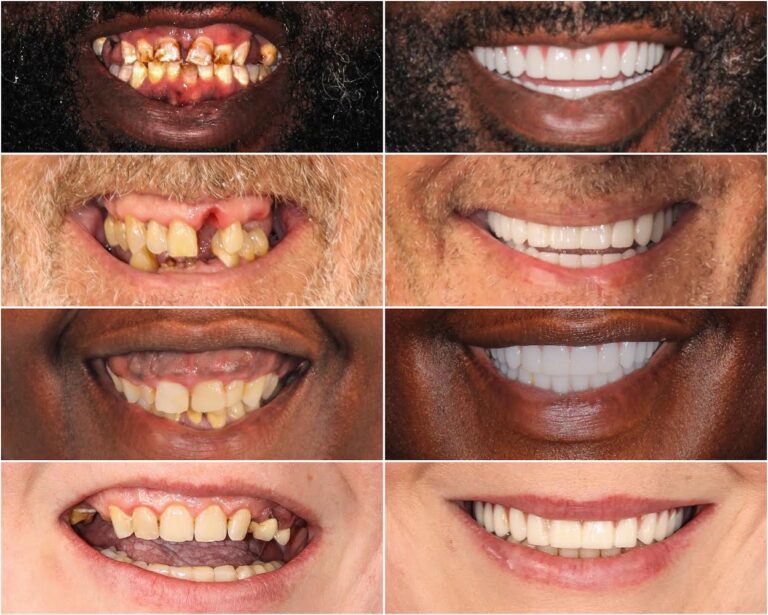 Surgical Management of the Dreaded High Smile Line - AOX Surgery