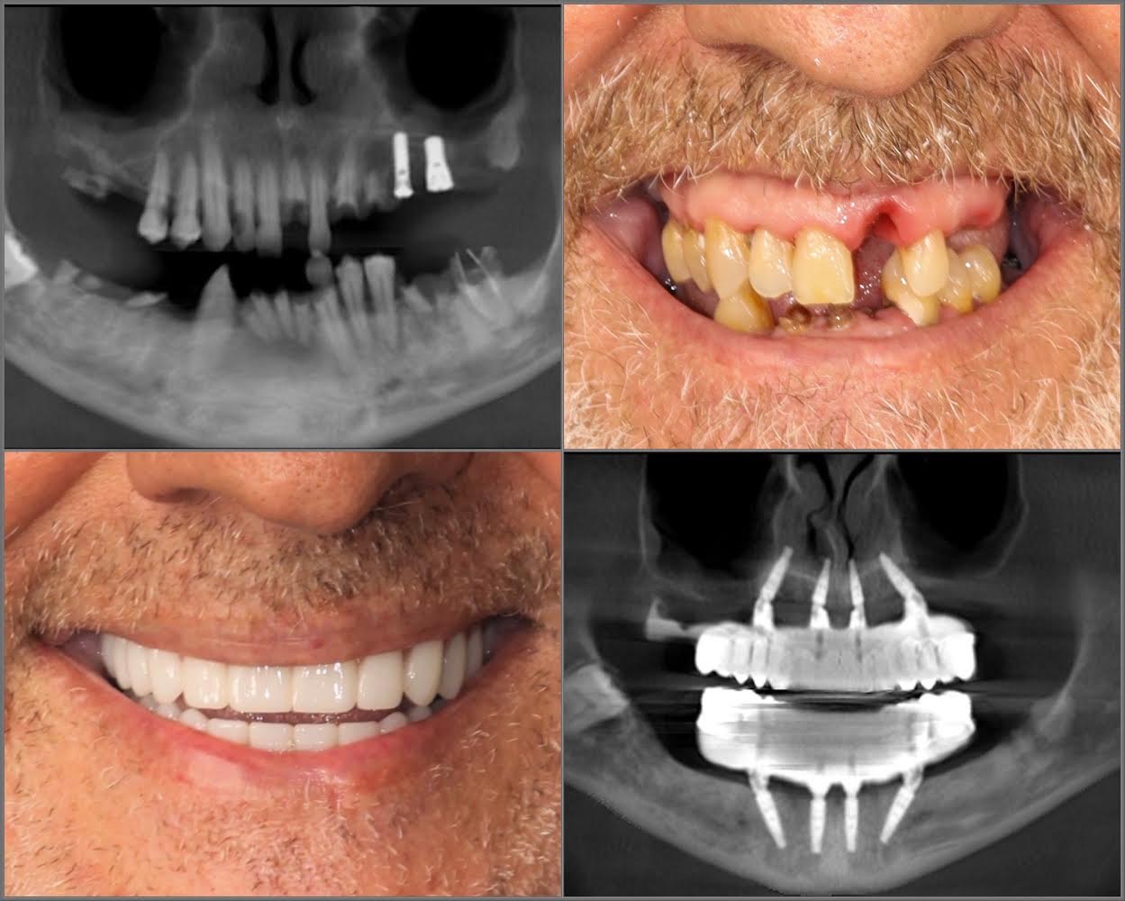 Surgical Management of the Dreaded High Smile Line - AOX Surgery