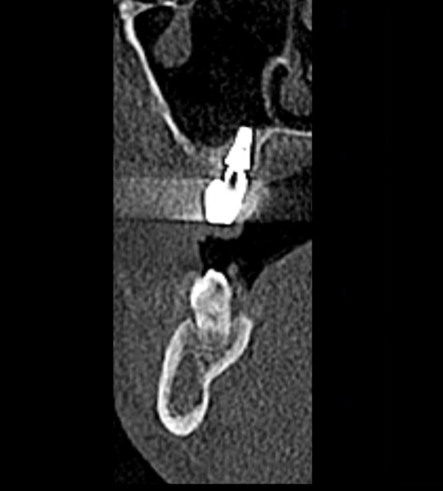 The Perks of a Palatal Root - AOX Surgery