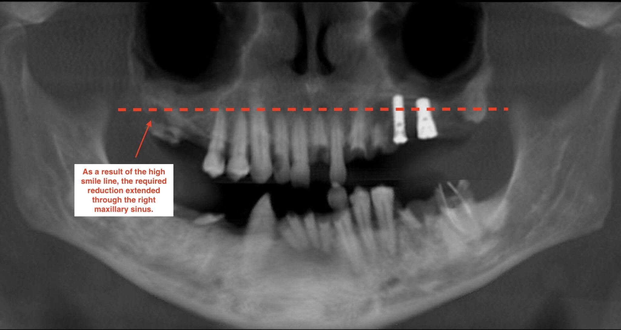 Surgical Management of the Dreaded High Smile Line - AOX Surgery