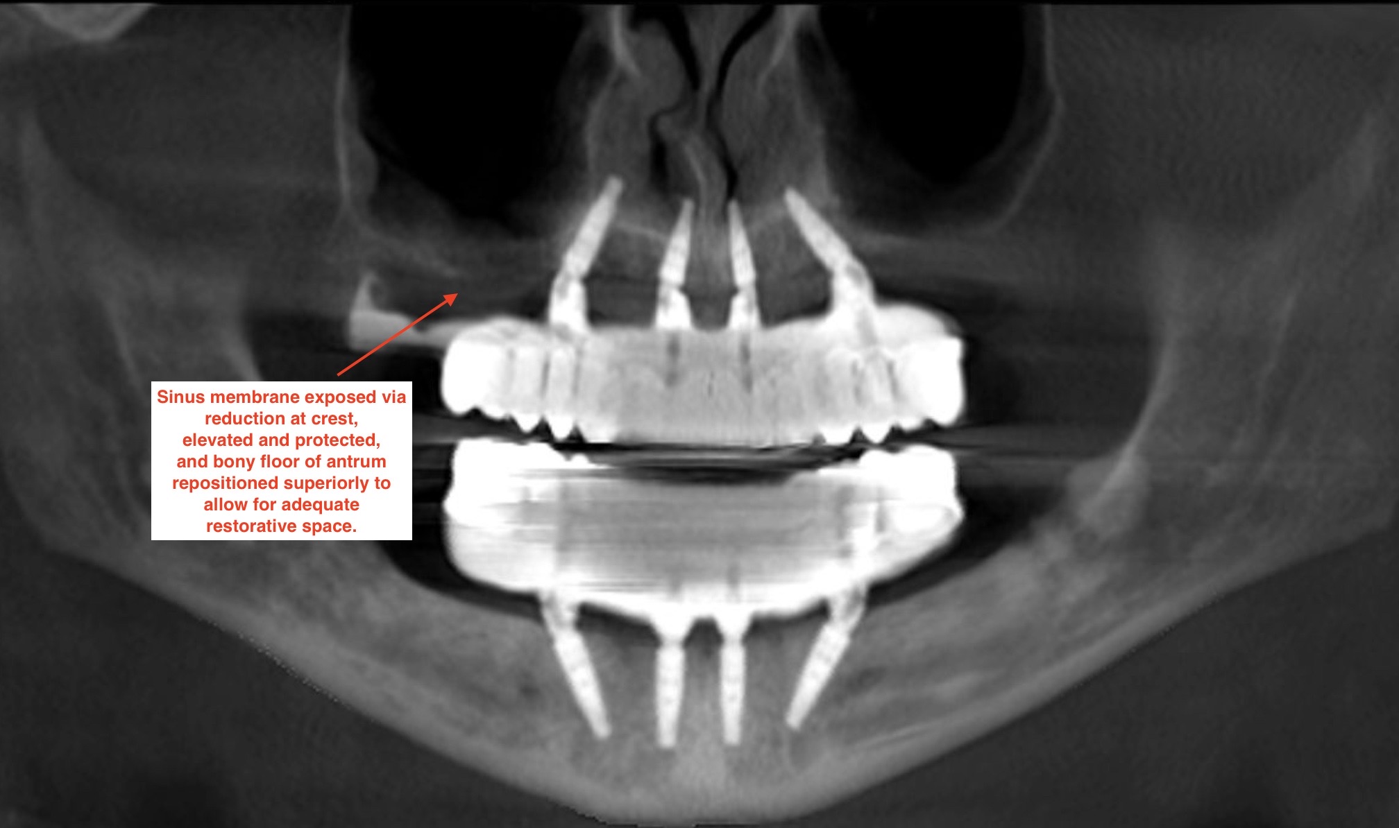 Surgical Management of the Dreaded High Smile Line - AOX Surgery