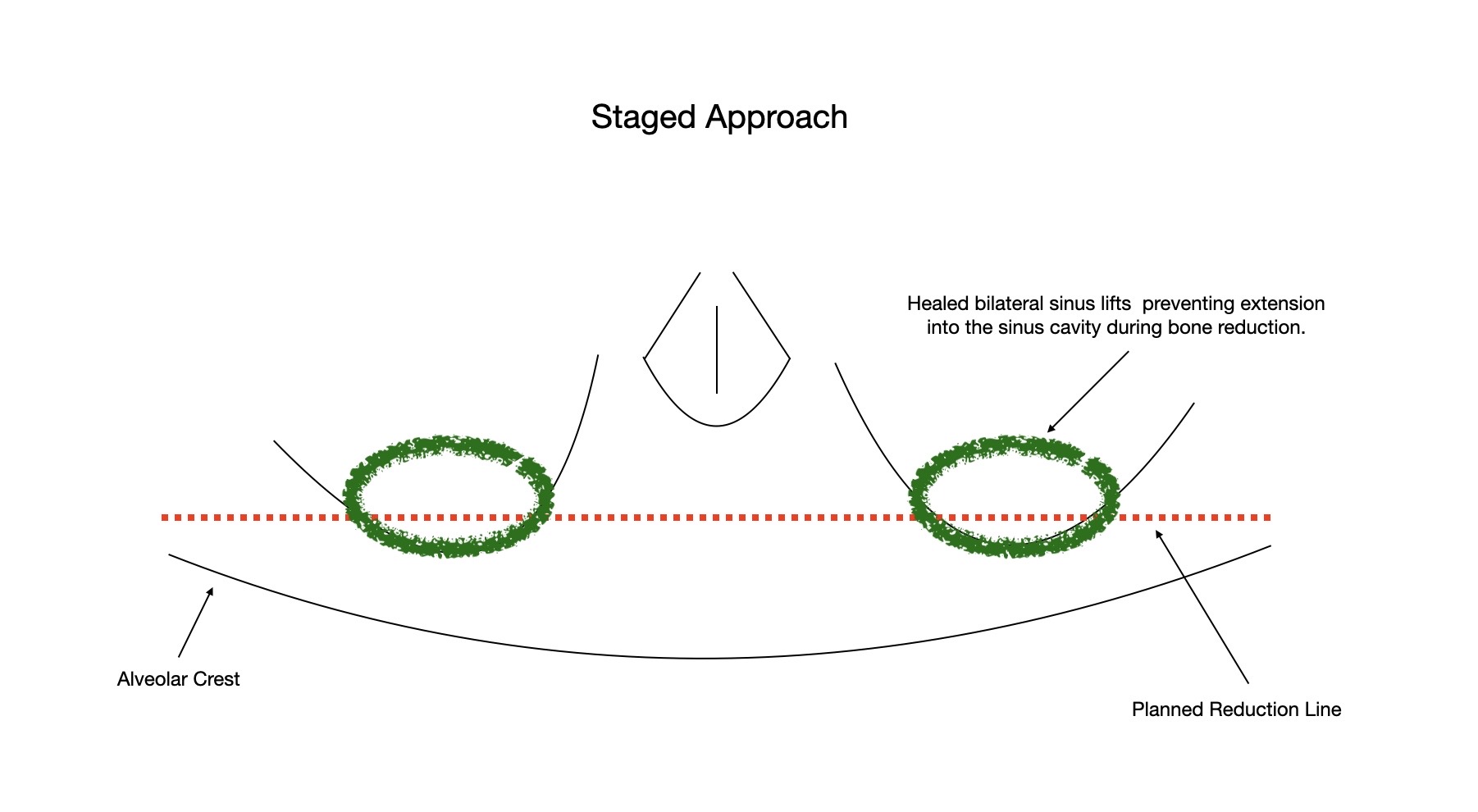 Surgical Management of the Dreaded High Smile Line - AOX Surgery