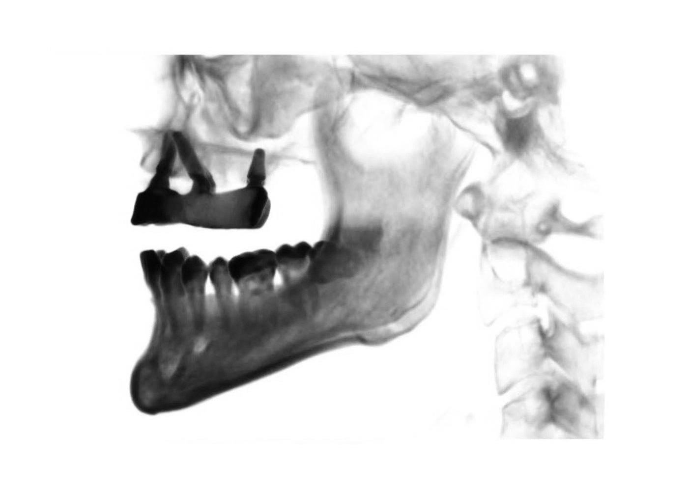 The Perks of a Palatal Root - AOX Surgery
